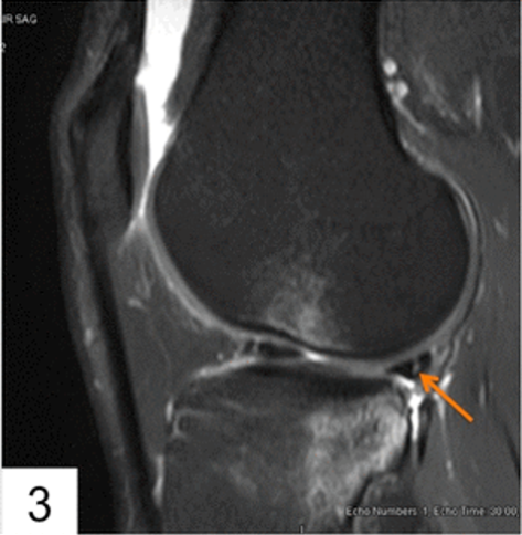 Caso del mes: Desgarro de Wrisberg